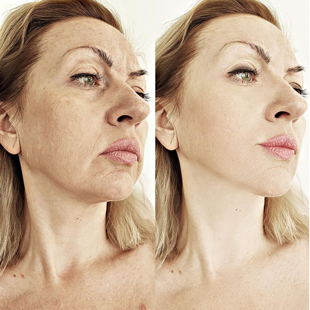 HIFU Skin Tightening | Non-Surgical Facelift | Luna-C